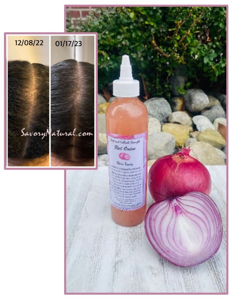 Red Onion Follicle & Root Strength Regrow Thinning Hair Stimulate ...