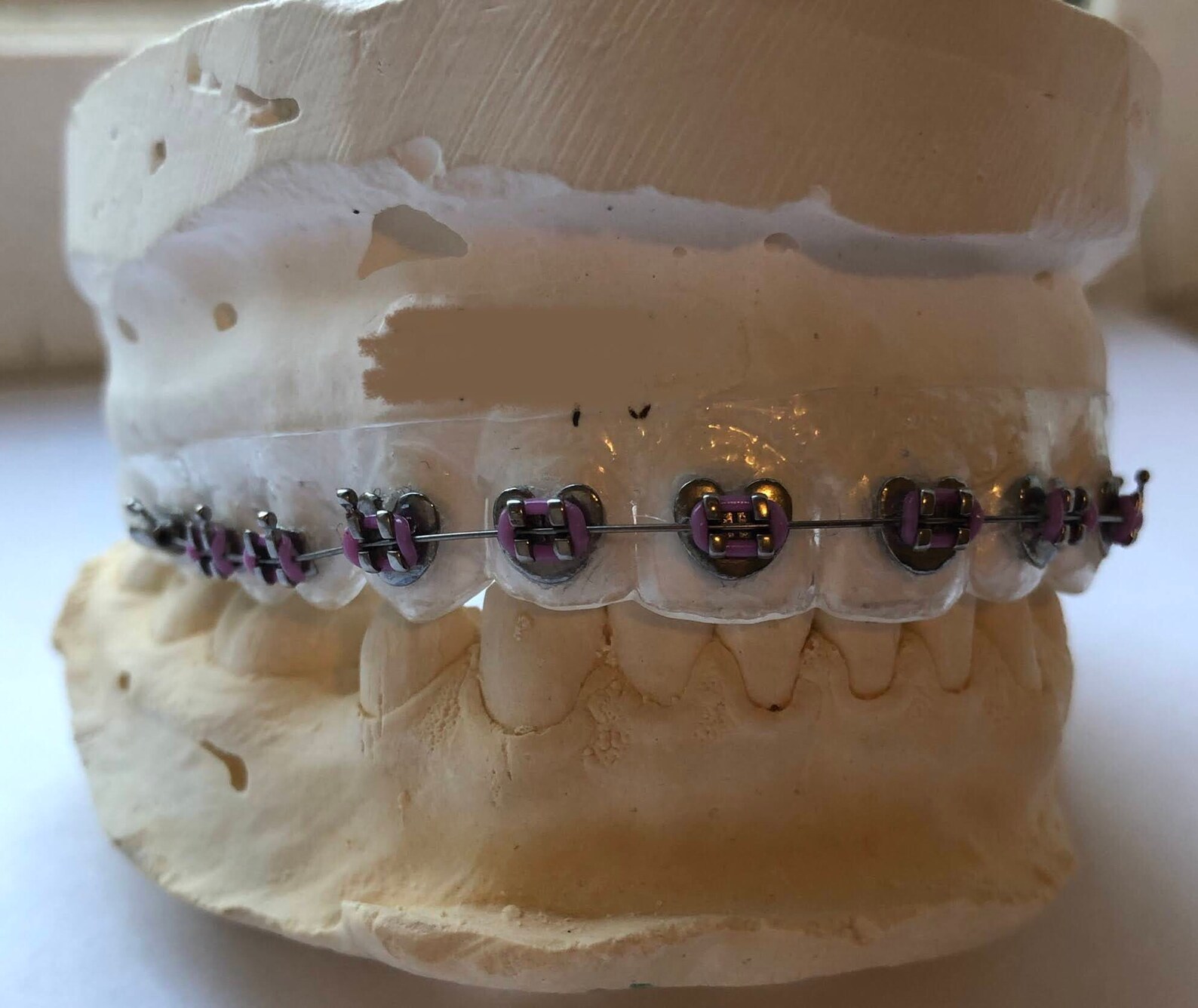 Heart Shape CUSTOM Fake Braces Prop Retainer with Brackets | Etsy