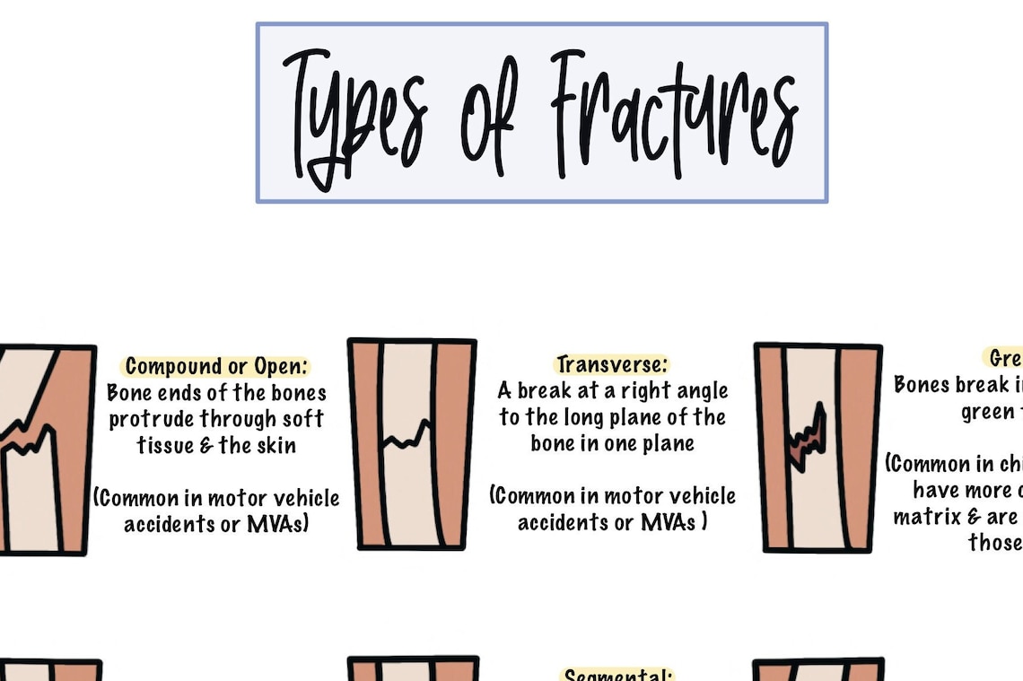 Types of Fractures Cheat Sheet - Etsy