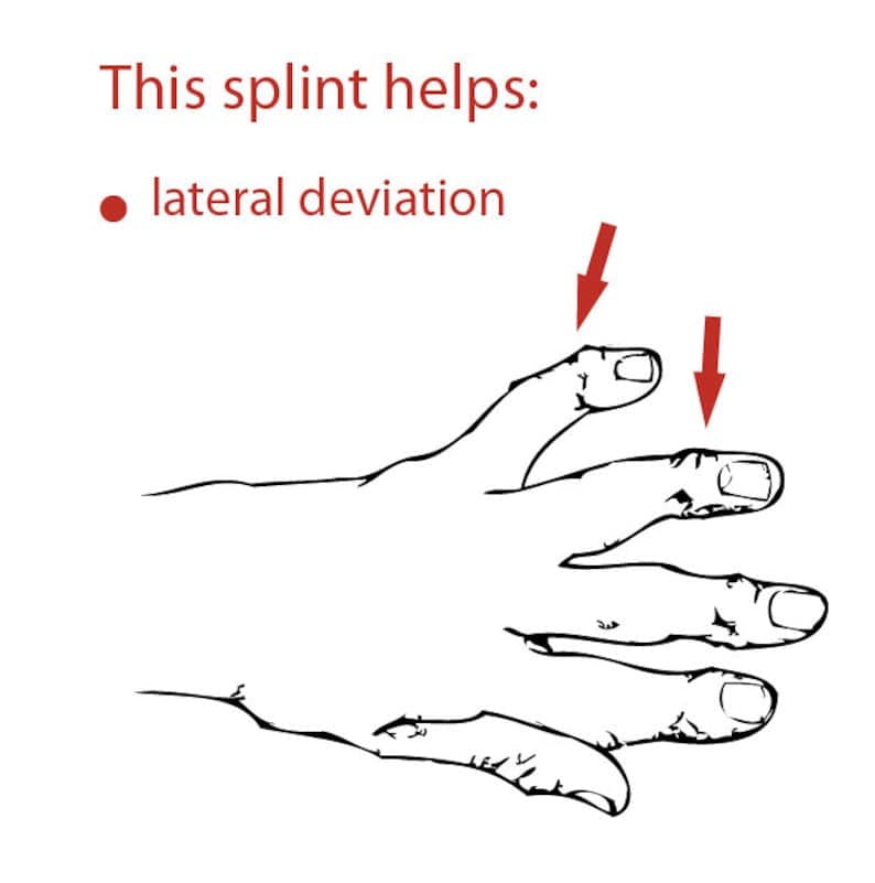 Arthritis Finger Splint for Bcnding Sideways Lateral Deviation - Etsy