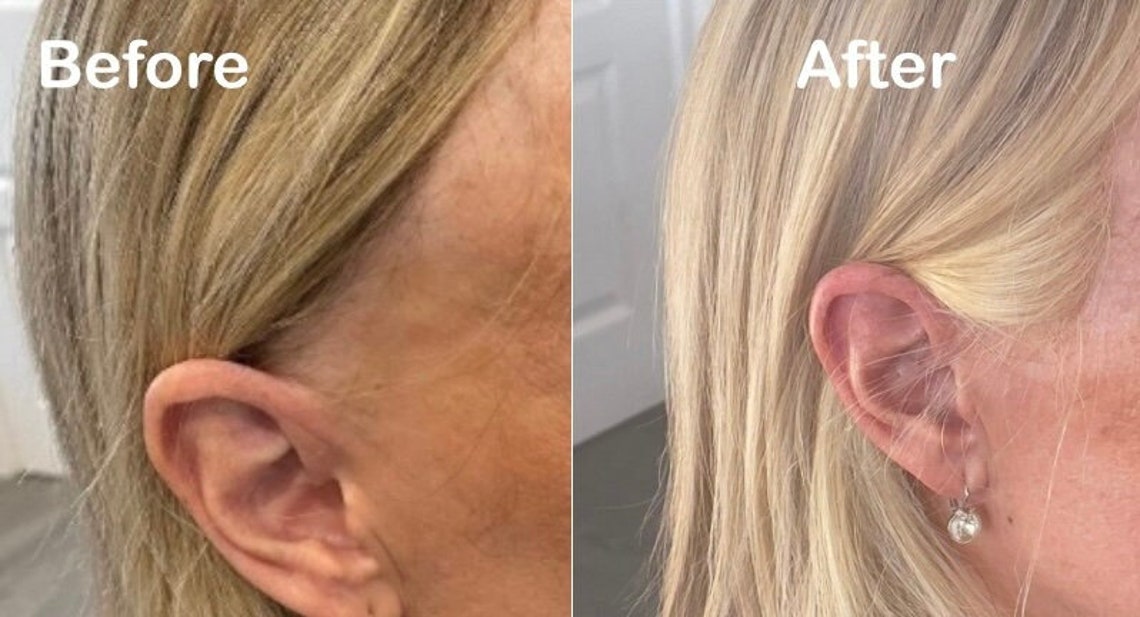 Bald Spot Cover up | Covers Bald Spots and Thinning Hair - Etsy Canada