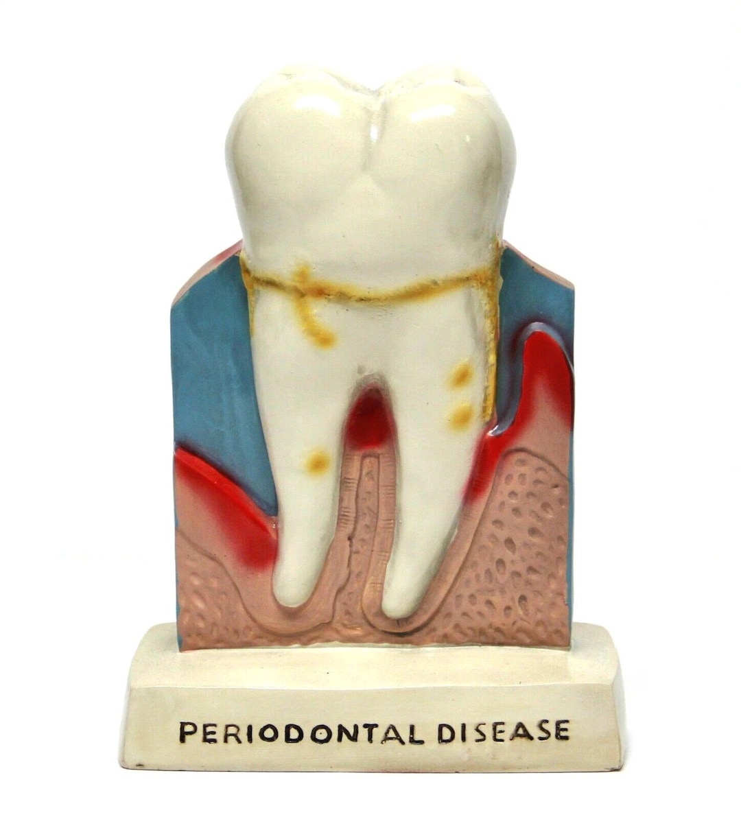 Vintage Dental Anatomy Model: Periodontal Disease & Gingivitis Teaching ...
