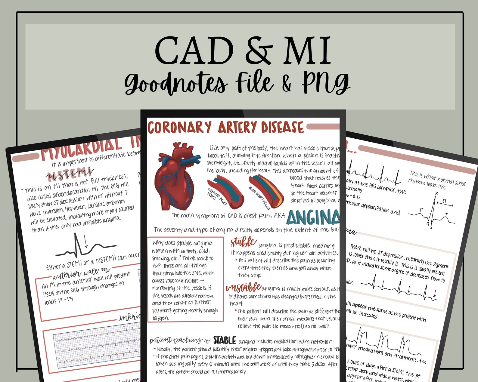 Coronary Artery Disease, Myocardial Infarction Nursing Notes // Digital ...