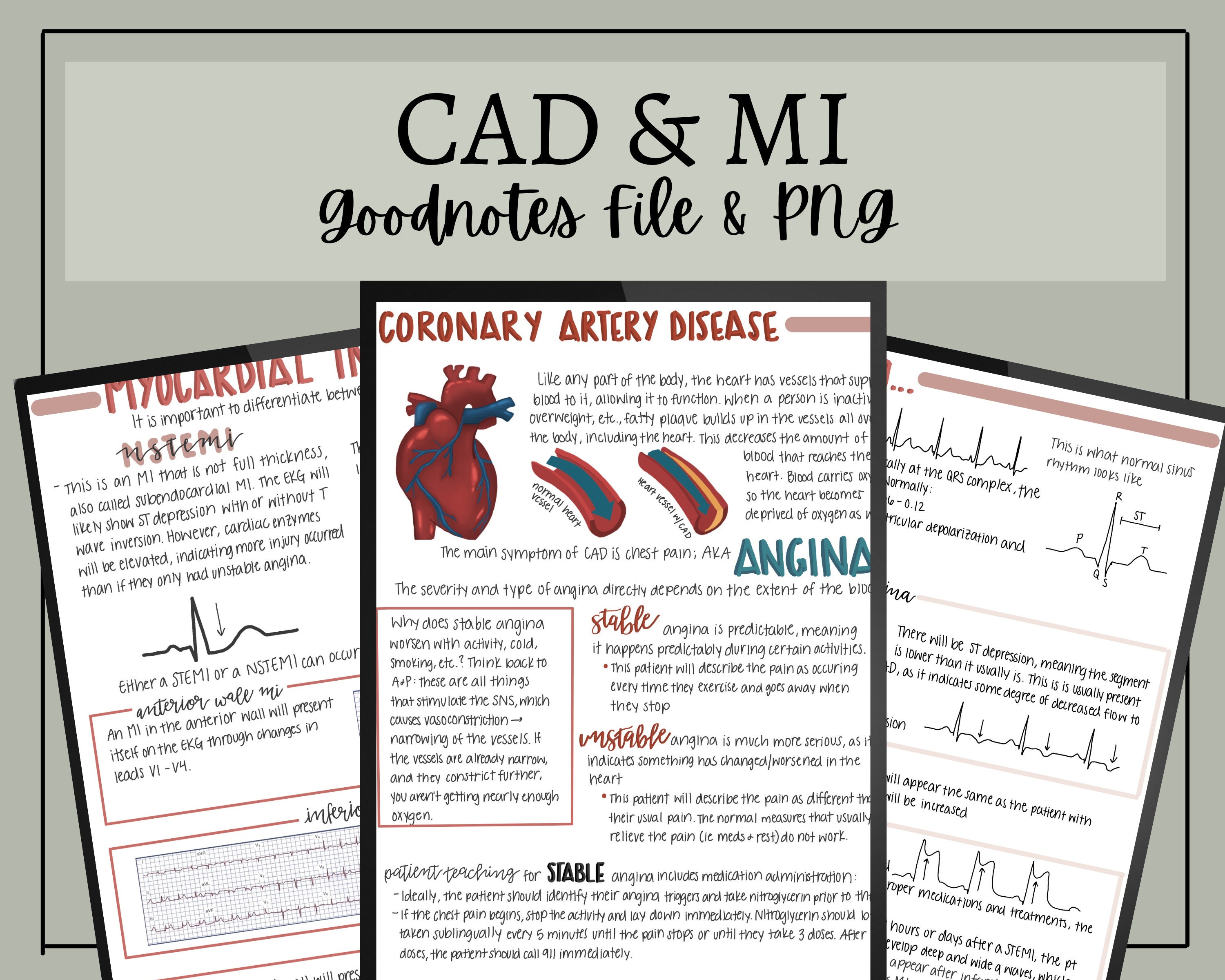 Coronary Artery Disease, Myocardial Infarction Nursing Notes // Digital ...