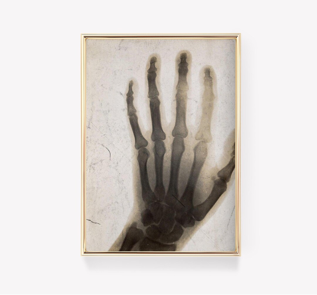 X-ray Hand Art | Wilhelm Röntgen | Vintage Print | Medical Poster ...