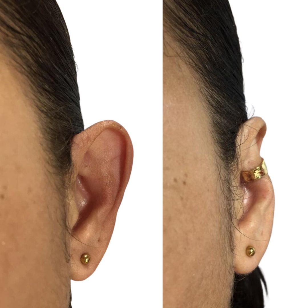 Big Ear Corrector aesthetic Ear Corrector - Etsy Hong Kong