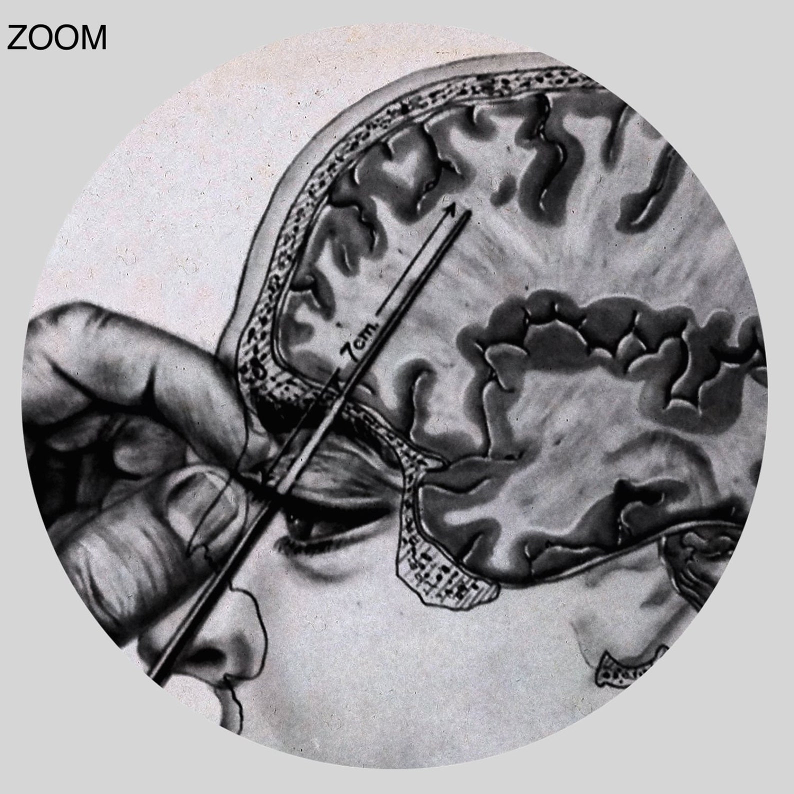 Transorbital Lobotomy Medical Illustration. Brain, Neurology ...