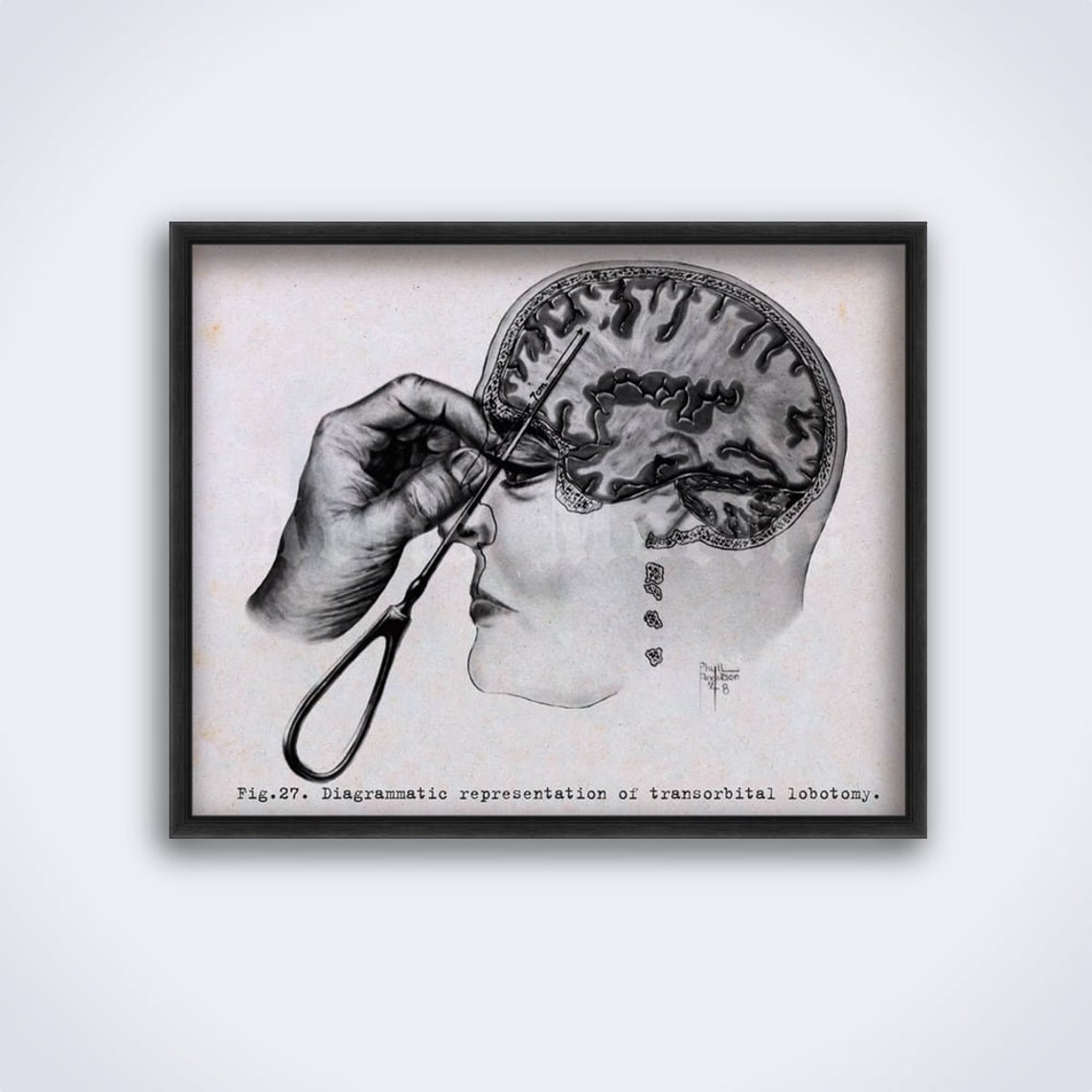 Transorbital Lobotomy Medical Illustration. Brain Neurology - Etsy