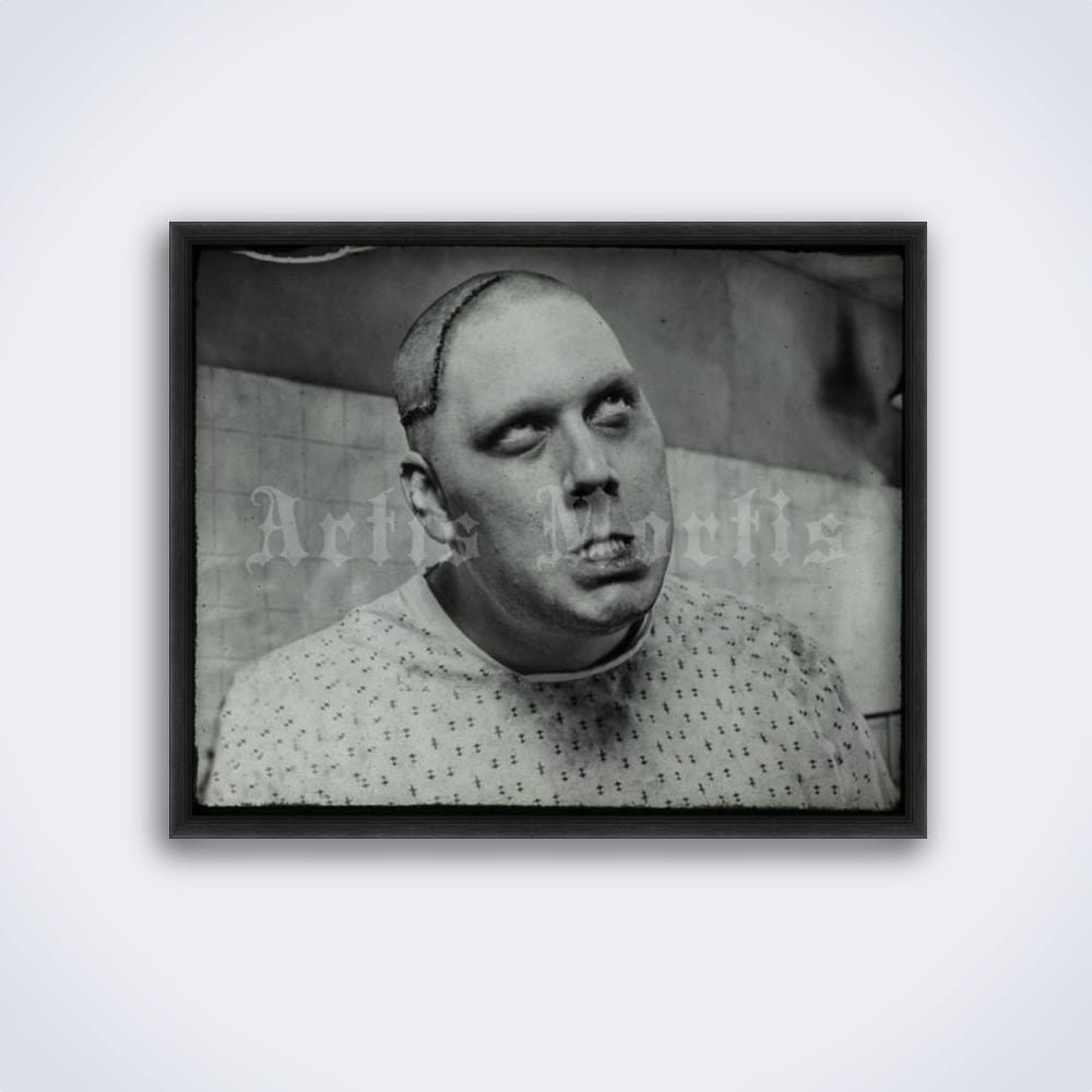 Psychosurgery Victim Medical Photo. Trepanning Lobotomy | Etsy