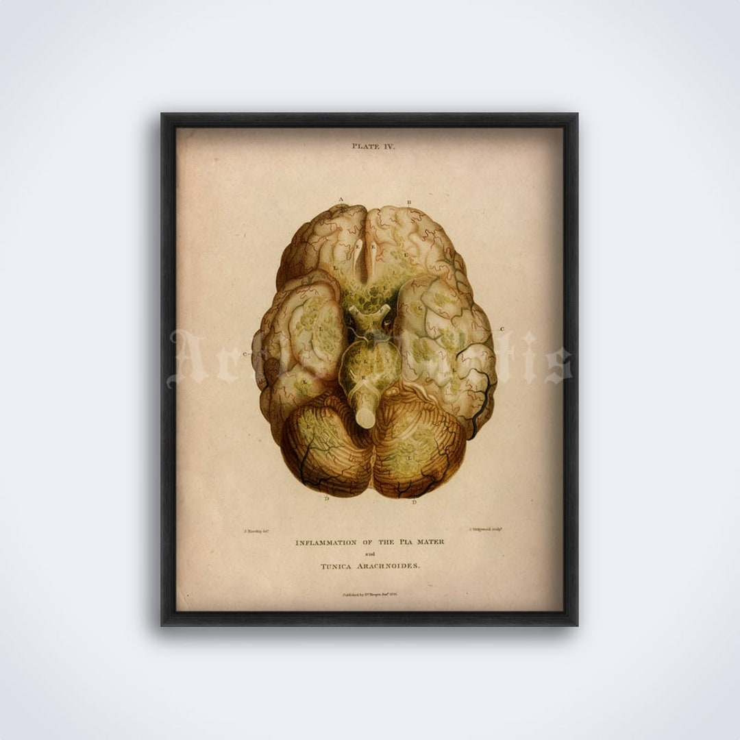 Human Brain Pathology, Morbid Anatomy Illustration. Neurology, Surgery ...