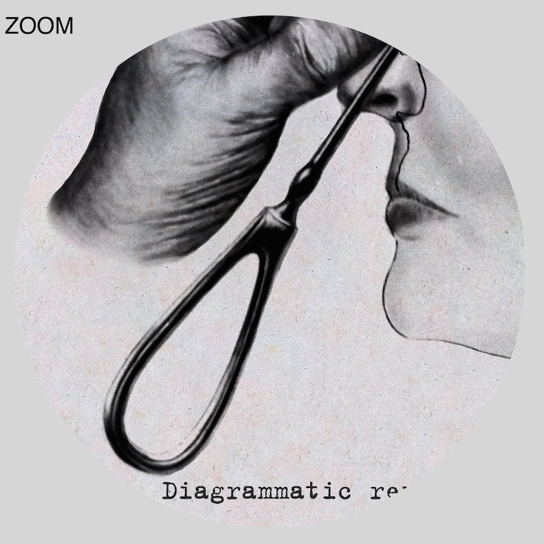 Transorbital Lobotomy Medical Illustration. Brain, Neurology ...