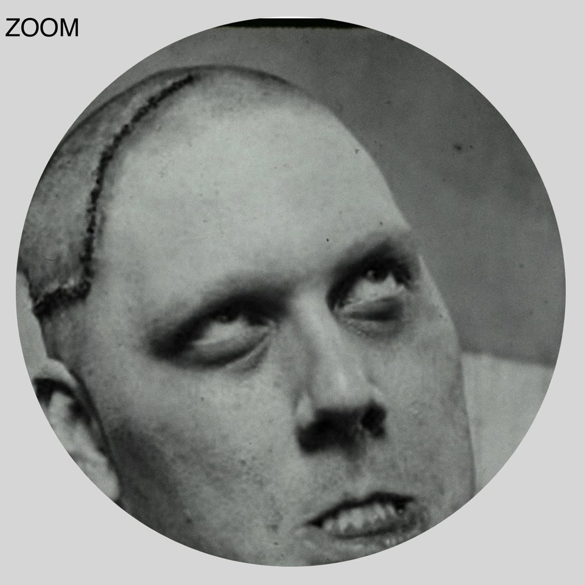 Psychosurgery Victim Medical Photo. Trepanning Lobotomy | Etsy