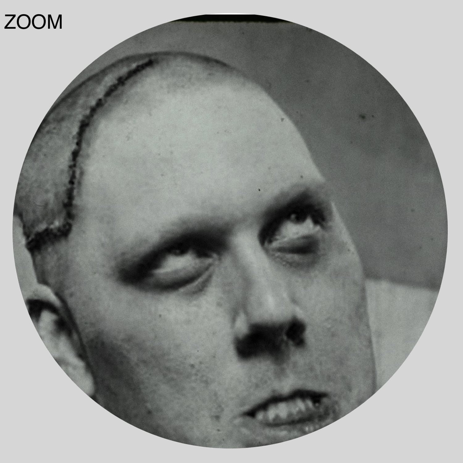 Psychosurgery Victim Medical Photo. Trepanning Lobotomy | Etsy