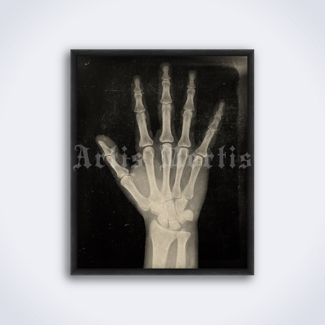 X-ray Human Hand – Anatomy, Radiology Photo, Vintage Medical Art Print ...