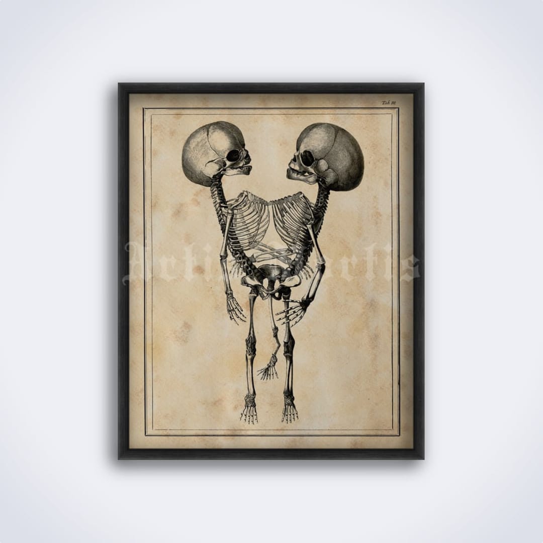 Conjoined Skeletons, Siamese Twins – Anatomy, Pathology, Oddities and ...