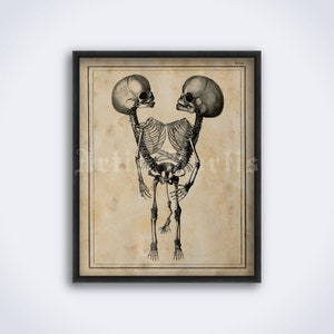 Conjoined Skeletons, Siamese Twins – Anatomy, Pathology, Oddities and ...