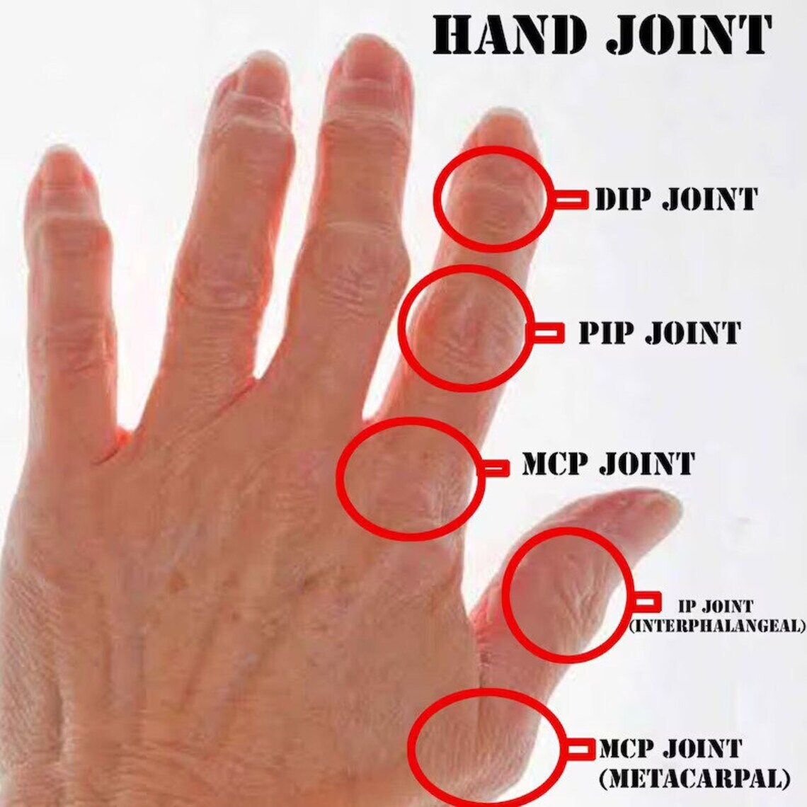Adjustable Swan Ring, Finger Splint for Eds/arthritis, Joint ...