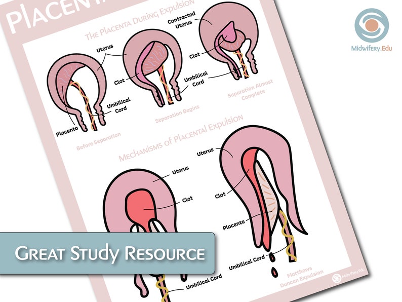 Placental Expulsion Educational Poster - Etsy