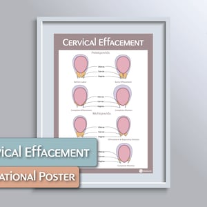 Cervical Effacement Educational Poster - Etsy