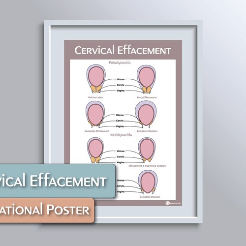 Cervical Effacement Educational Poster - Etsy