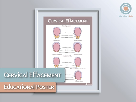 Cervical Effacement Educational Poster | Etsy