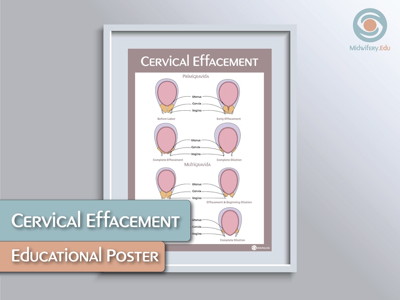 Cervical Effacement Educational Poster - Etsy