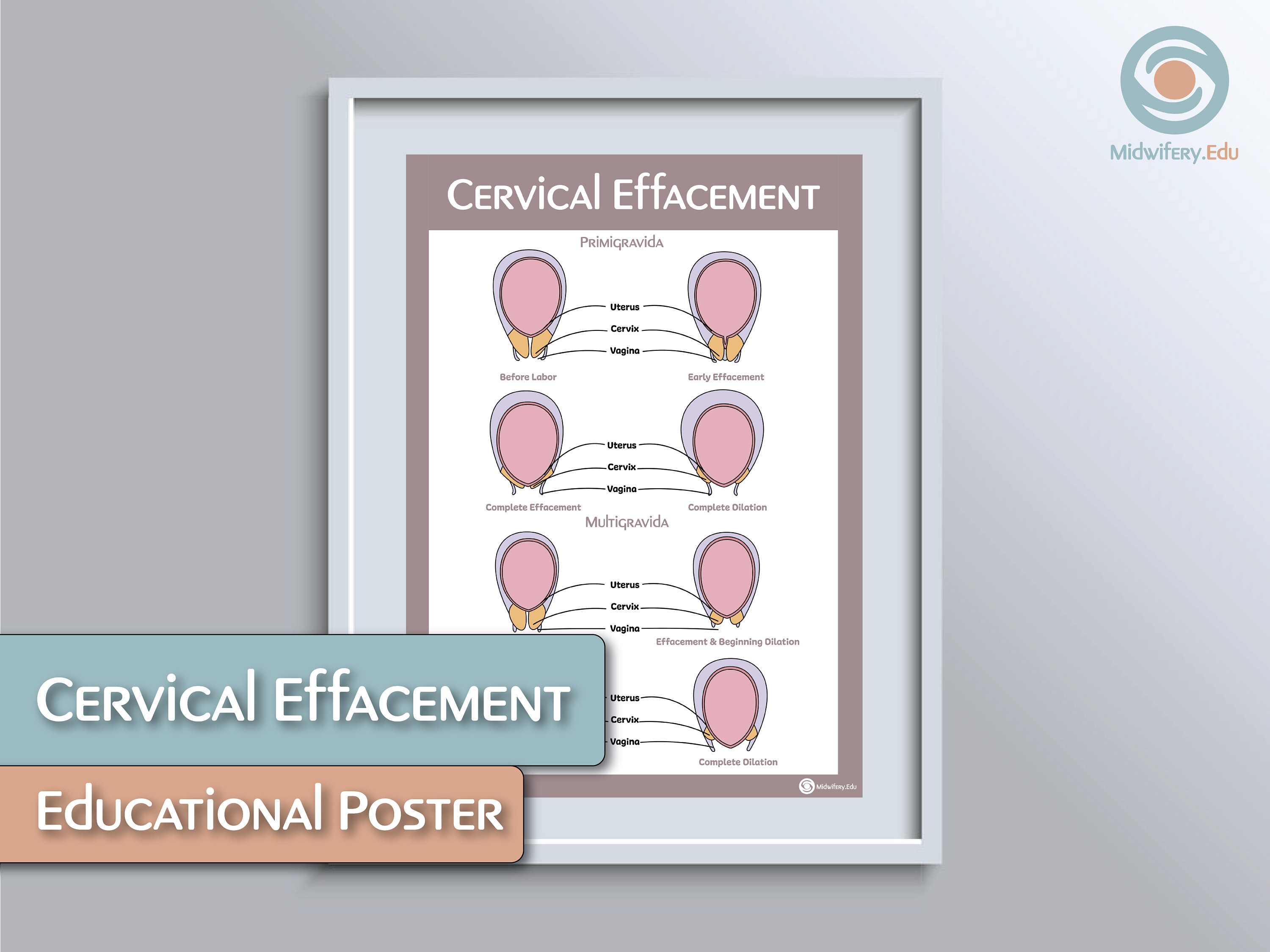 Cervical Effacement Educational Poster - Etsy UK
