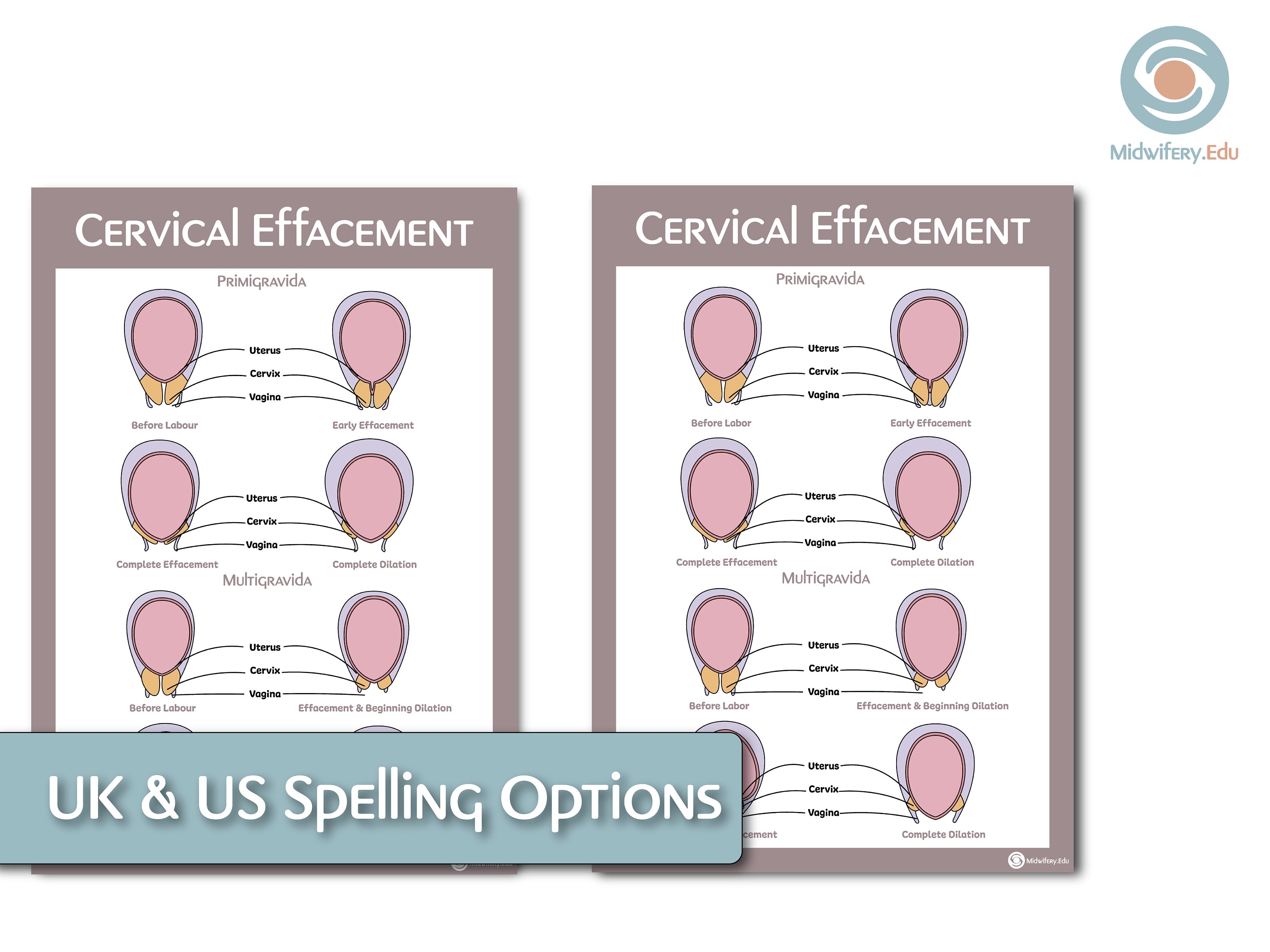 Cervical Effacement Educational Poster - Etsy