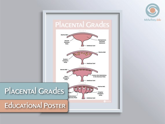 Placenta Grading Educational Poster | Etsy