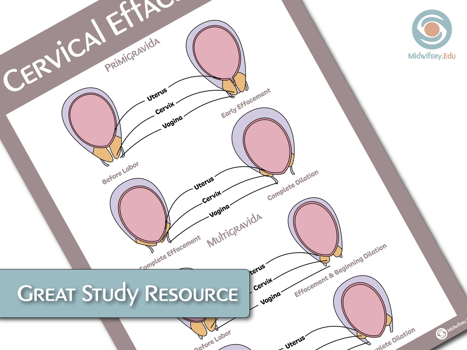 Cervical Effacement Educational Poster - Etsy UK