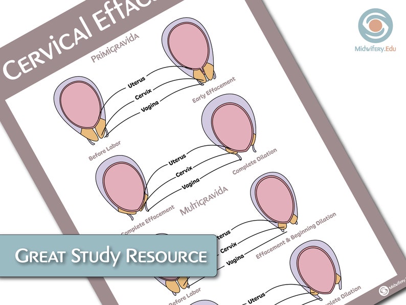 Cervical Effacement Educational Poster - Etsy
