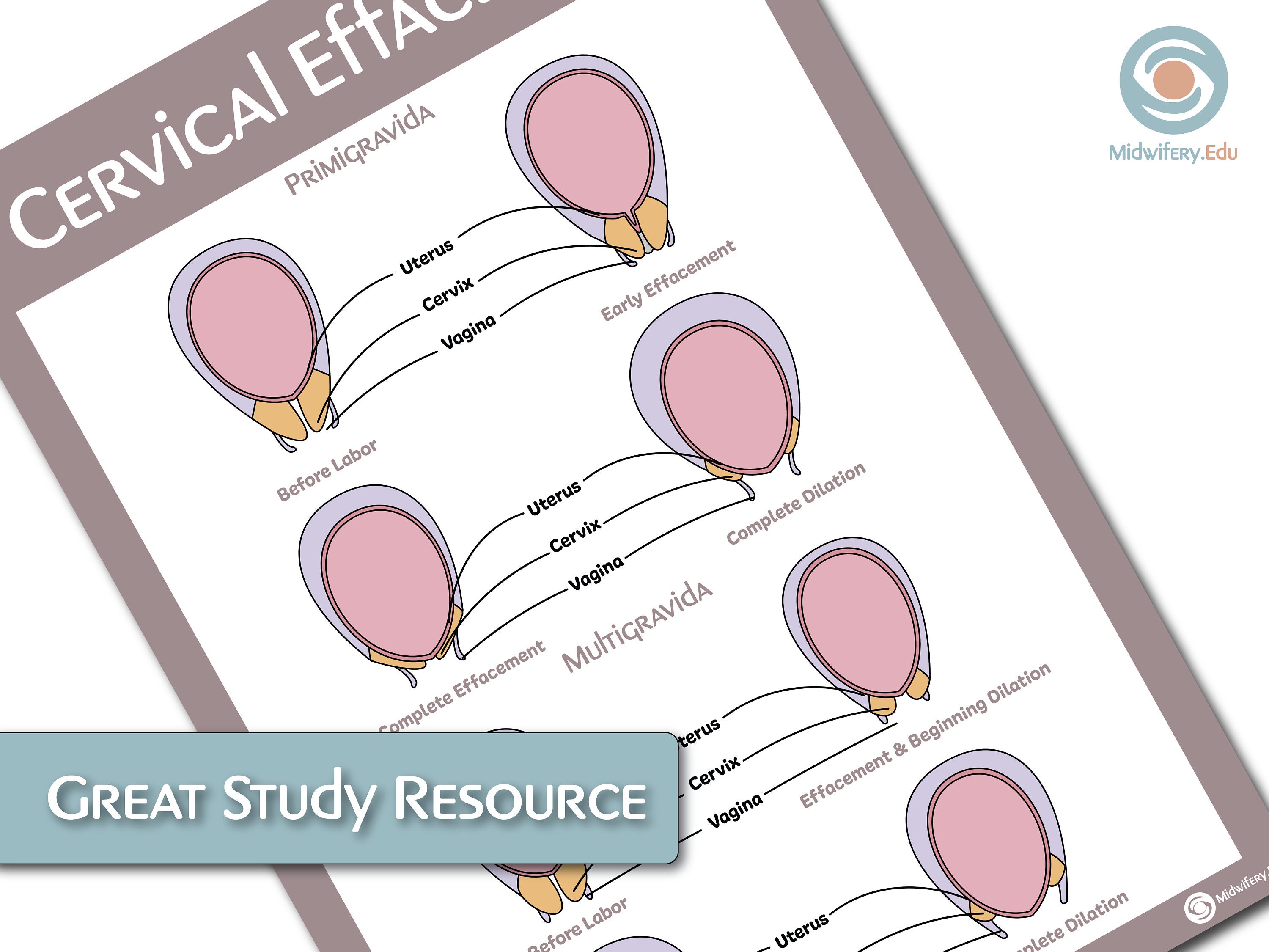 Cervical Effacement Educational Poster - Etsy UK