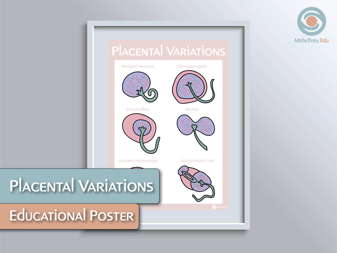 Placenta Variations Educational Poster - Etsy