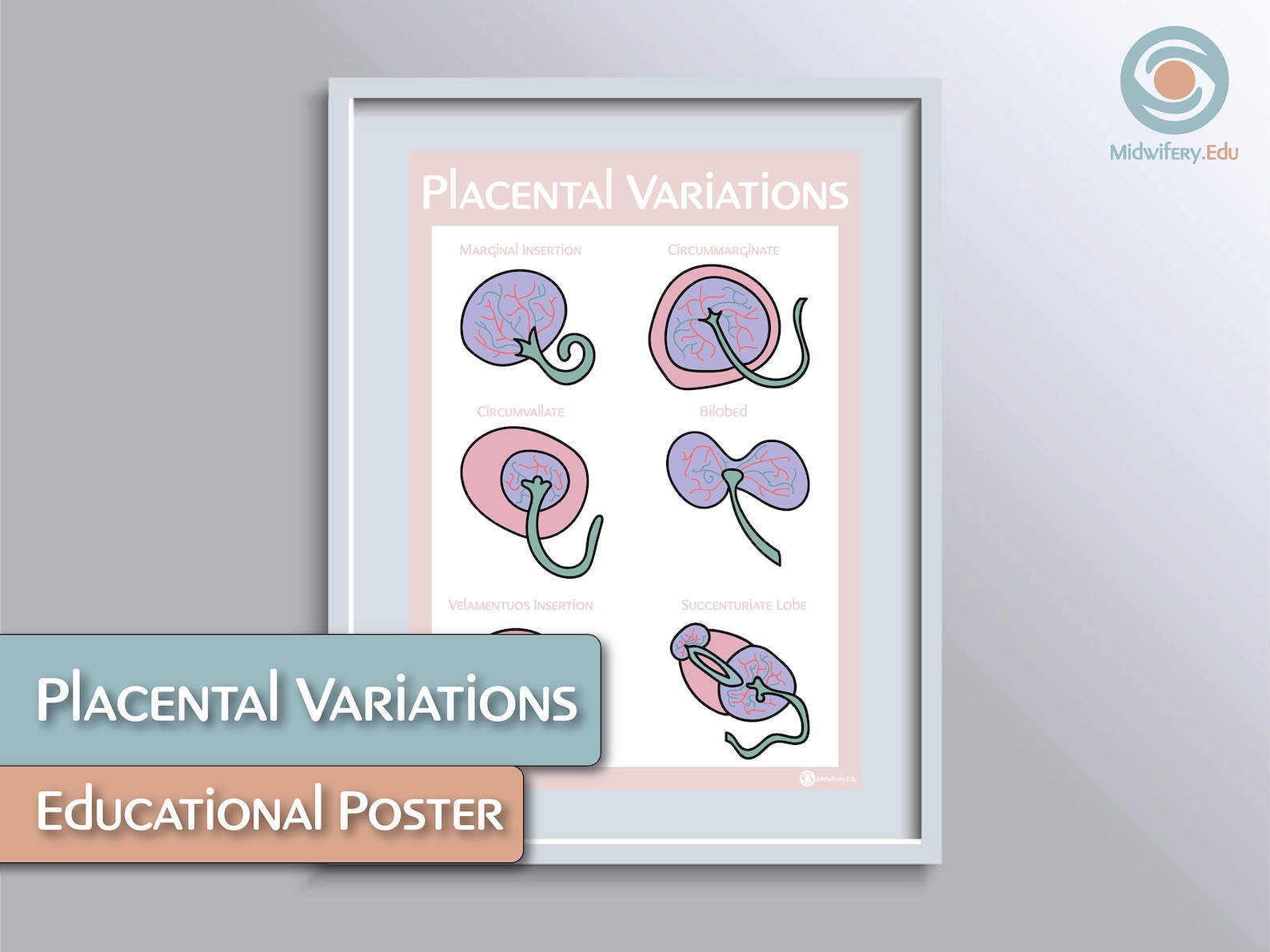 Placenta Variations Educational Poster - Etsy