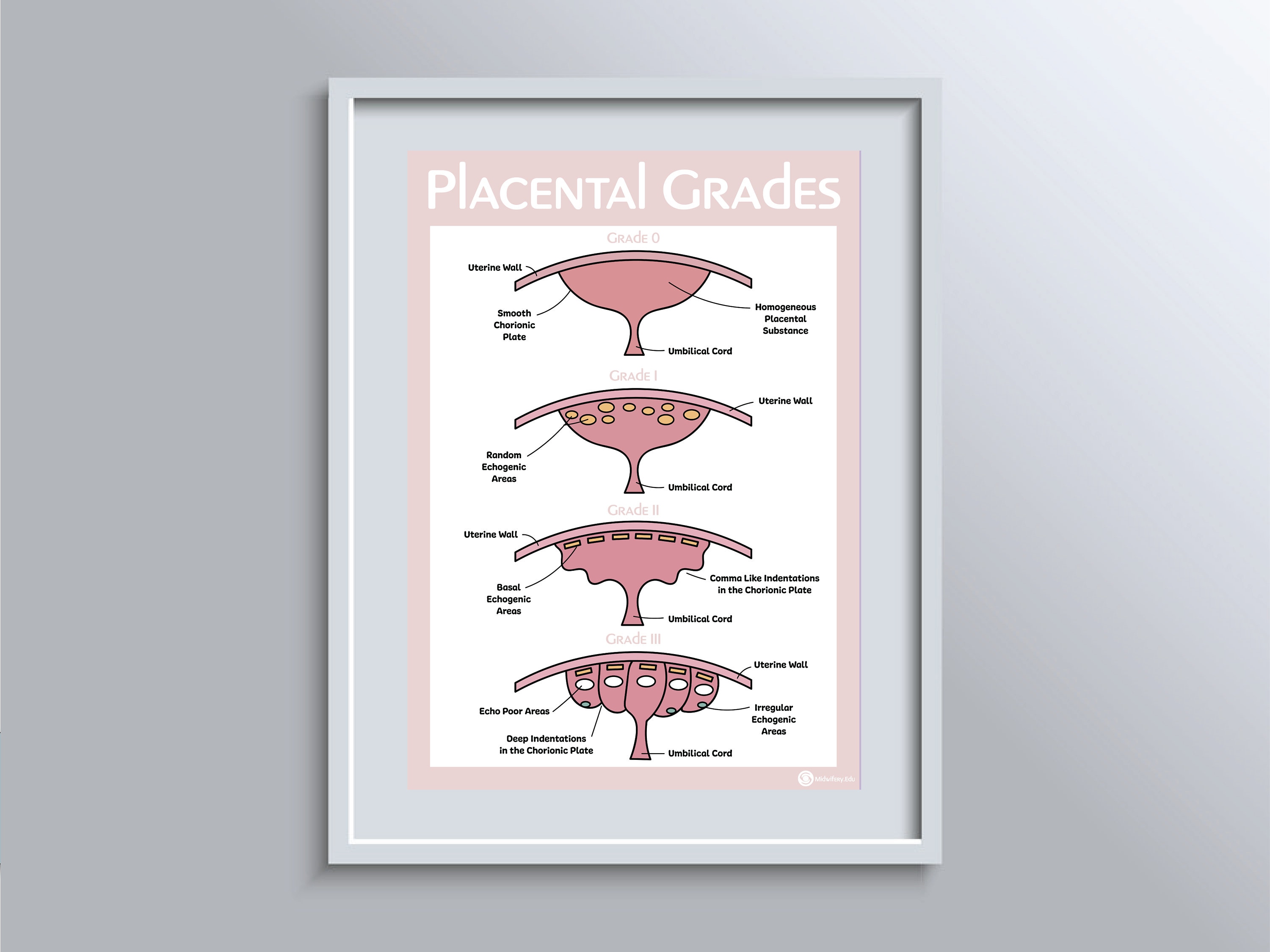Placenta Grading Educational Poster - Etsy