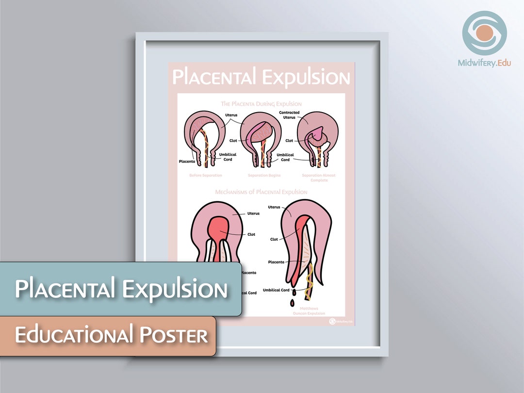 Placental Expulsion Educational Poster - Etsy