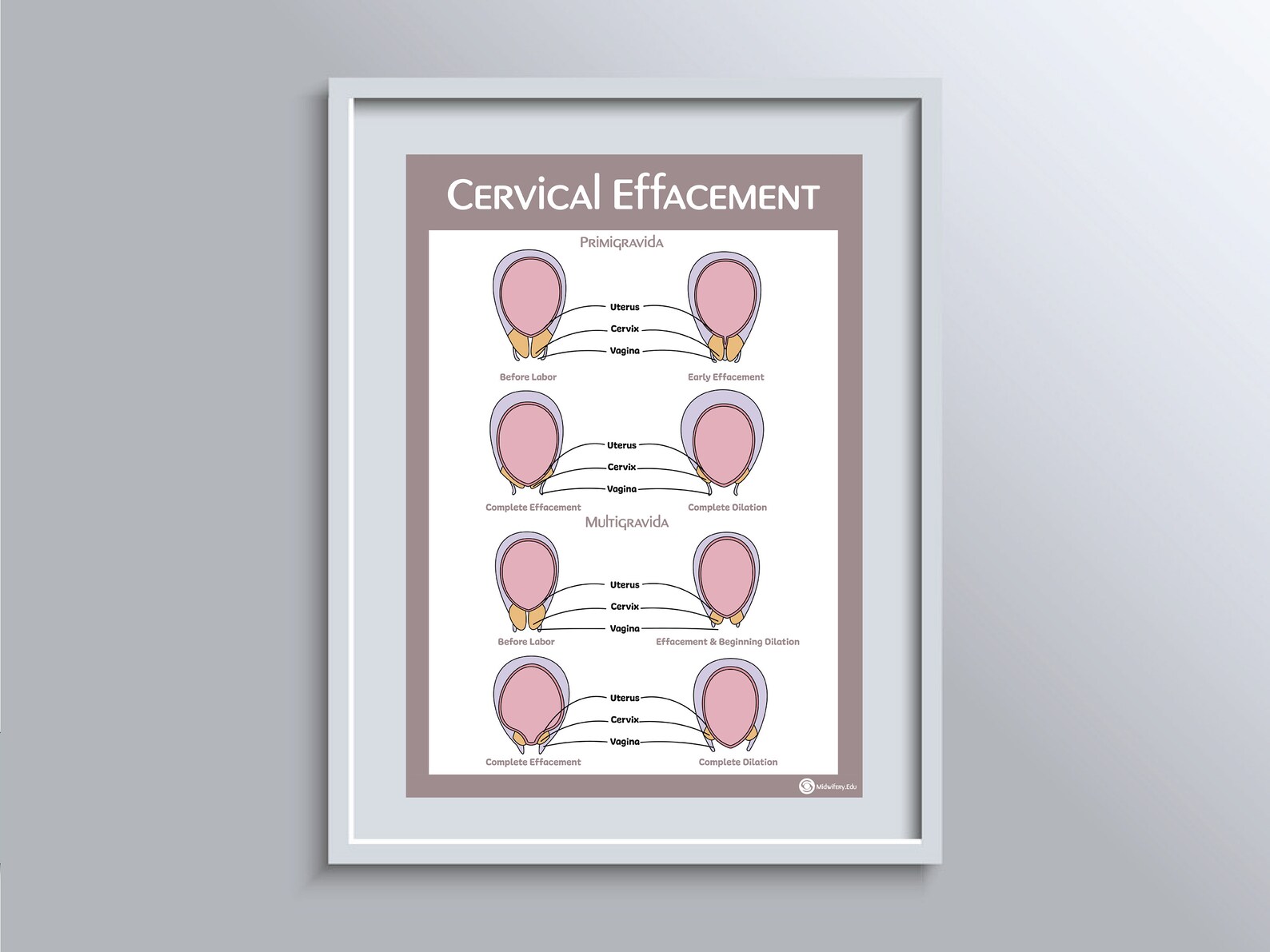 Cervical Effacement Educational Poster - Etsy UK