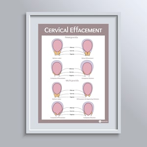 Cervical Effacement Educational Poster - Etsy