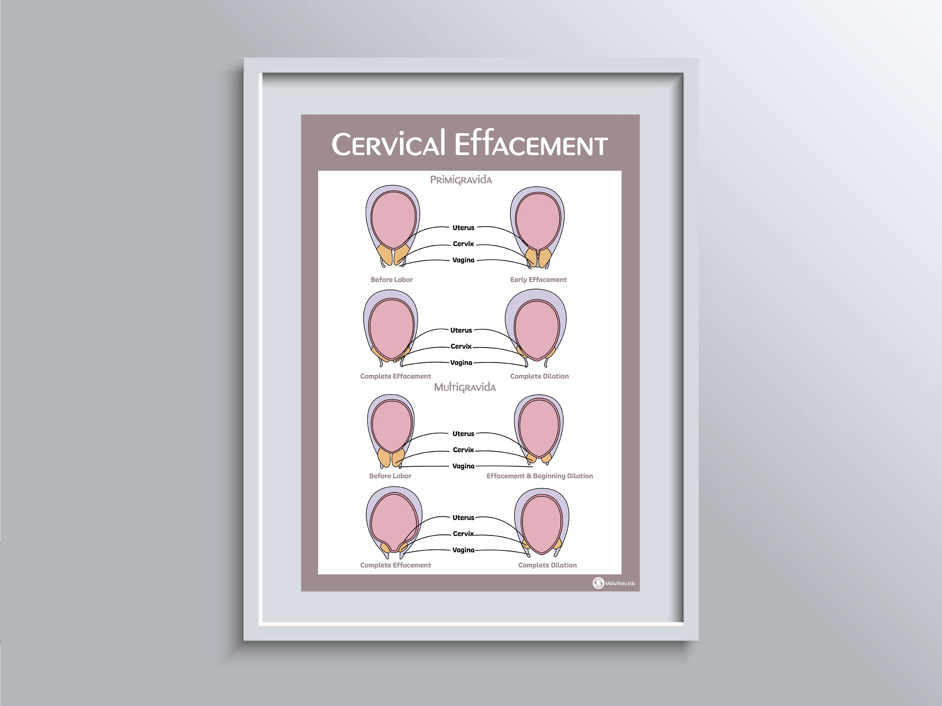 Cervical Effacement Educational Poster - Etsy Norway