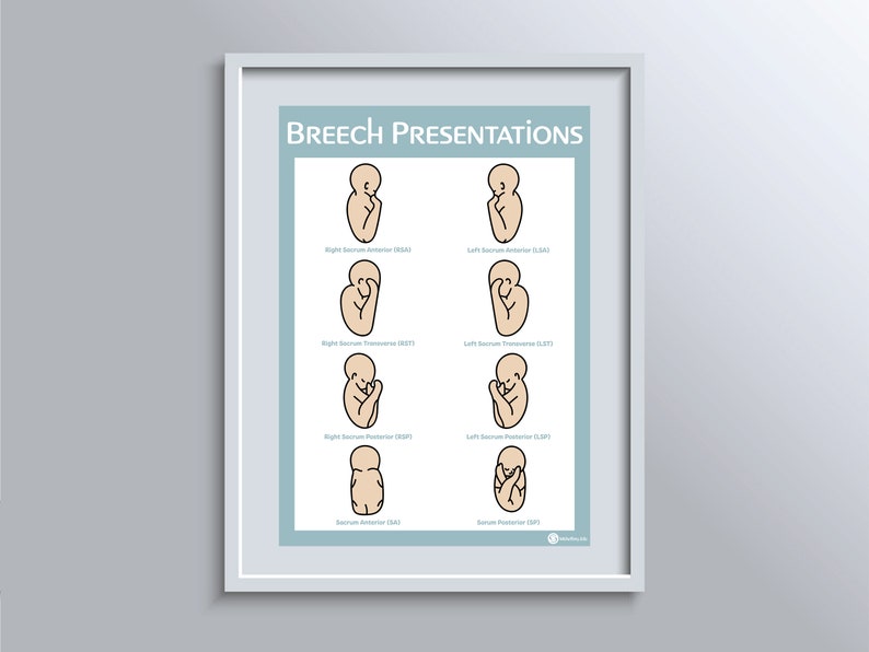 Breech Presentations Educational Poster - Etsy