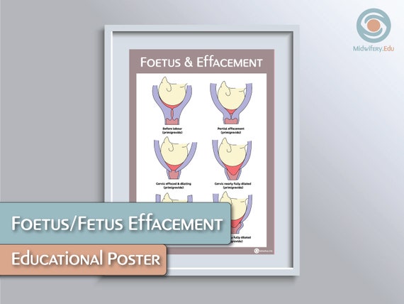 Foetus/fetus and Effacement Educational Poster | Etsy