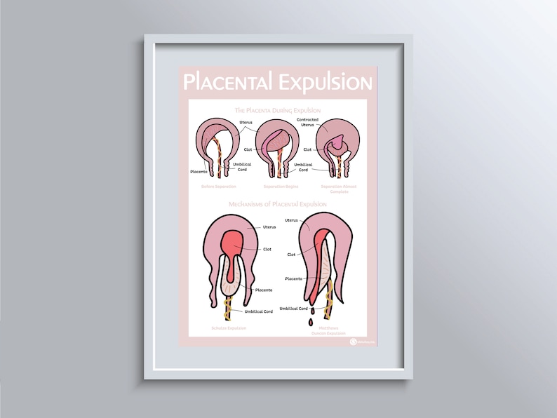 Placental Expulsion Educational Poster - Etsy