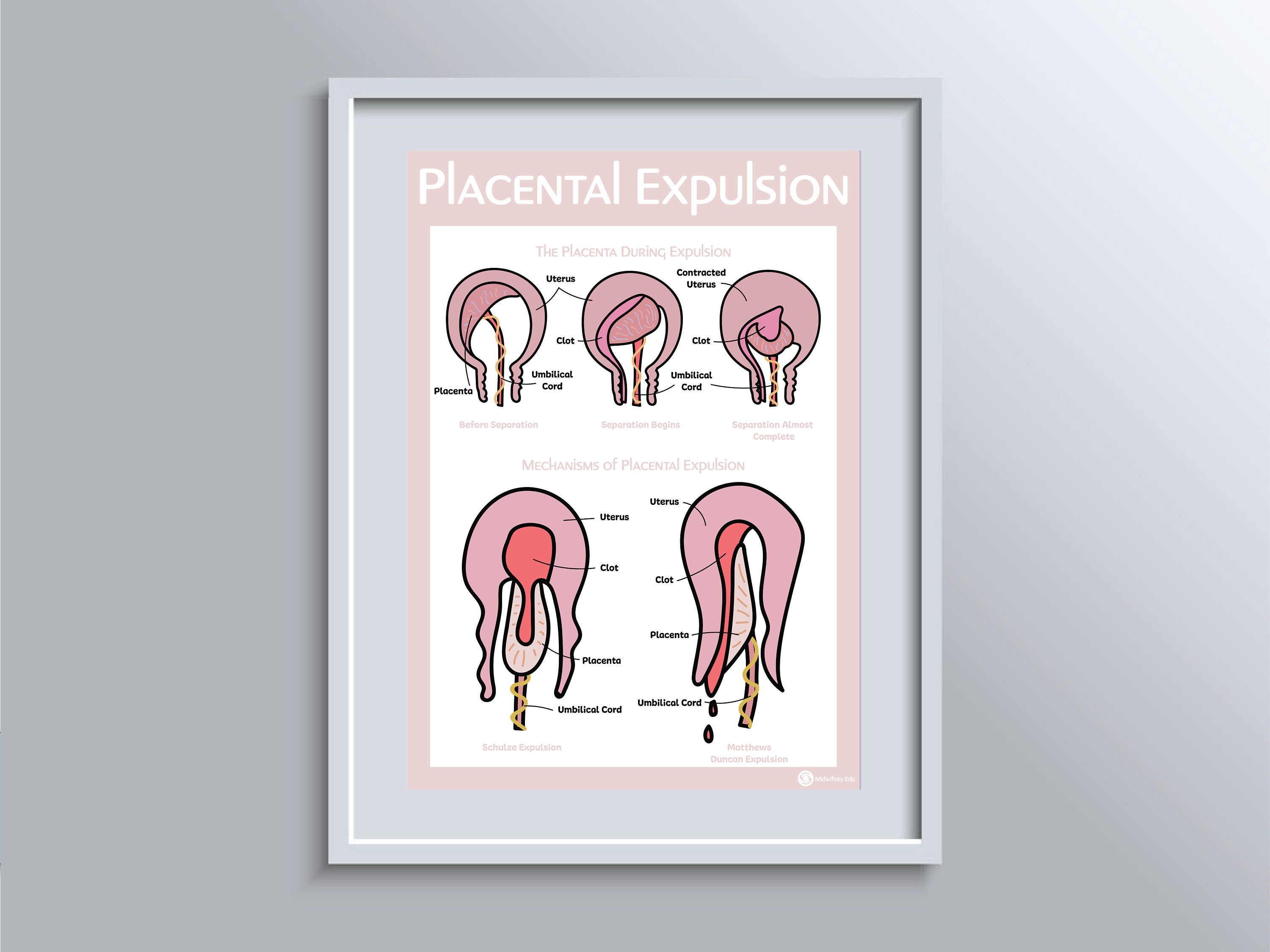 Placental Expulsion Educational Poster - Etsy