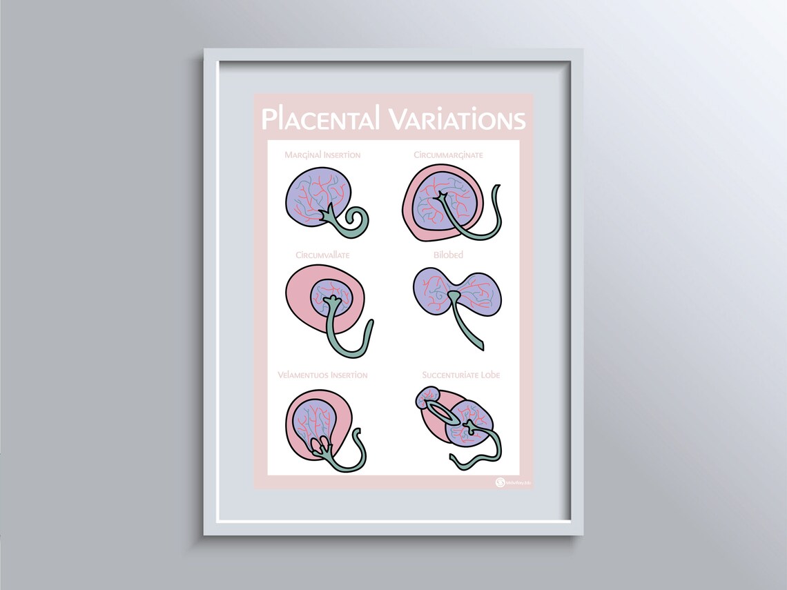 Placenta Variations Educational Poster - Etsy