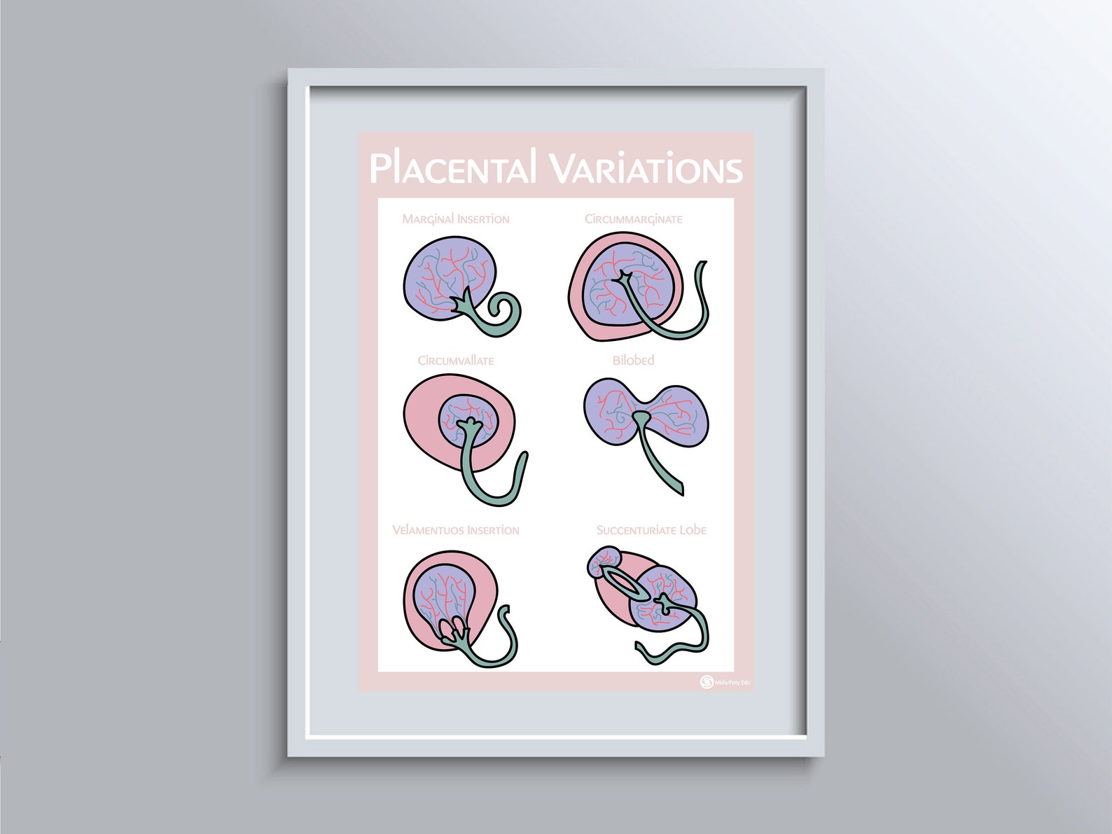 Placenta Variations Educational Poster - Etsy