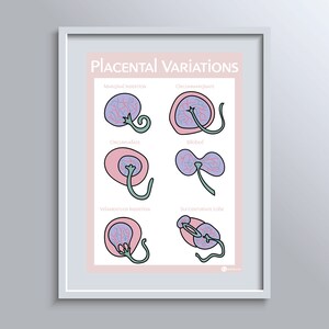 Placenta Variations Educational Poster - Etsy