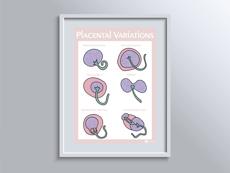 Placenta Variations Educational Poster - Etsy