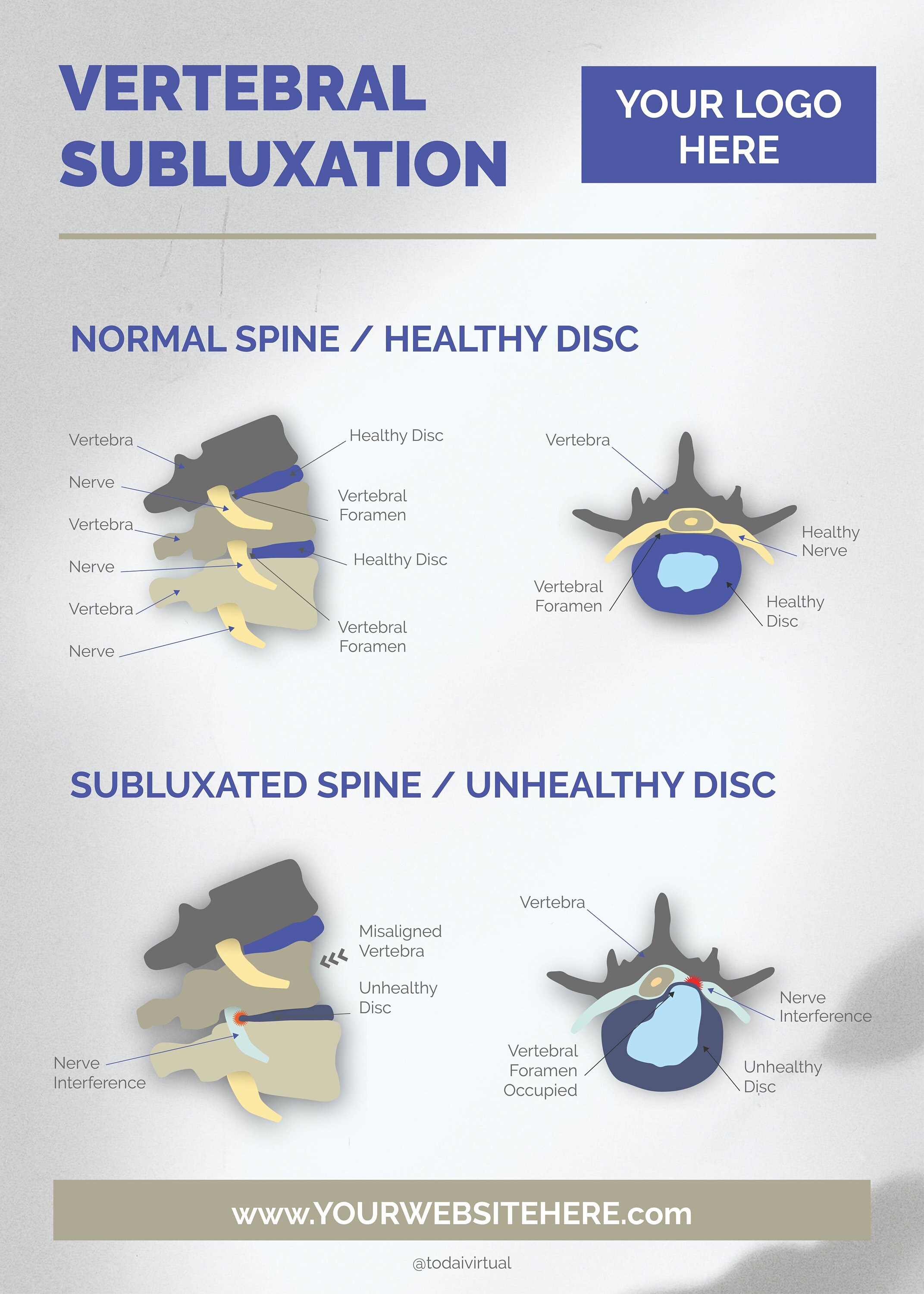 DIGITAL PDF Vertebral Subluxation Chiropractic Poster Chiropractic Deco ...