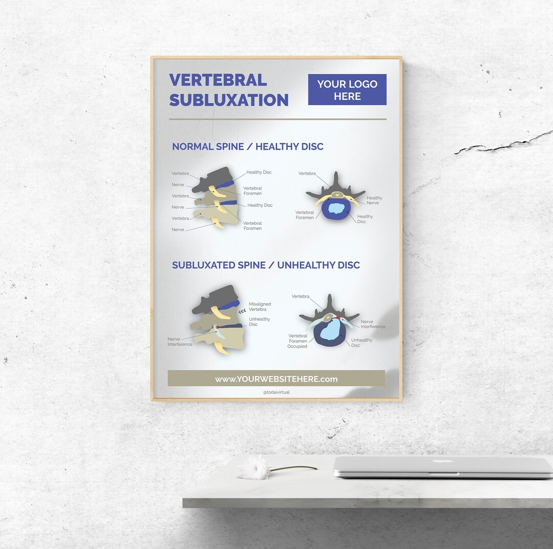 DIGITAL PDF Vertebral Subluxation Chiropractic Poster Chiropractic Deco ...