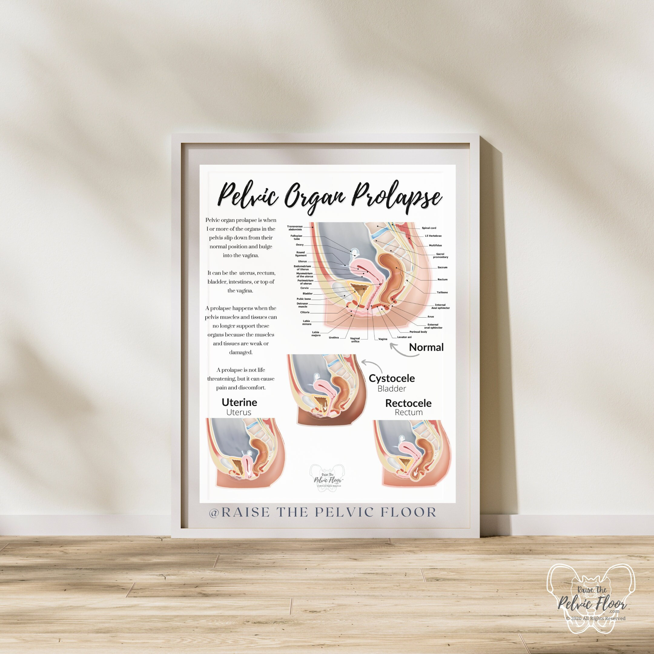 Prolapse Definition Art Print of Bladder, Rectum, & Uterus | Cystocele ...